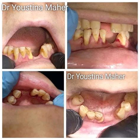 Youstina Maher On Linkedin Subginival And Supra Gingival Scaling