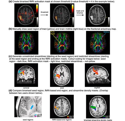 Workflow For Generation Of Streamlines Using Fmri And Diffusion Mri