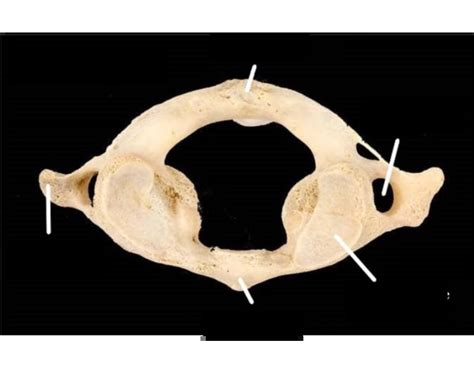 Atlas Vertebrae Labeling — Printable Worksheet