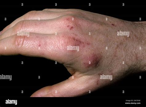 Cat Scratch Disease On The Hand Of A Male Patient The Bumps On The