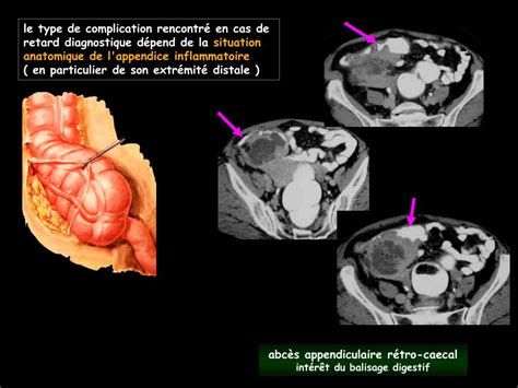 Ppt Pourquoi Le Scanner Dans Lappendicite Aiguë Et Ses Complications