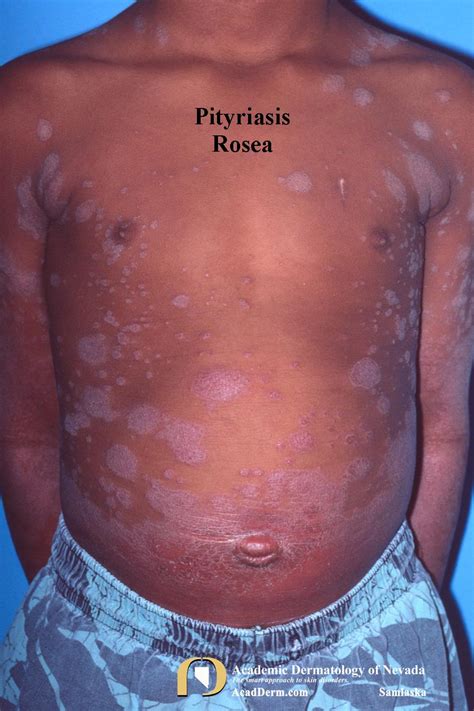 Christmas Tree Rash Pityriasis Rosea At Dominic Johnson Blog