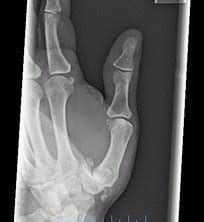 Thumb Arthritis Xray Hyperpronated View Radiograph Of Th Flickr