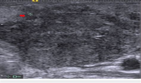 Malignant Cervical Node Shows Irregularill Defined Borders More Or