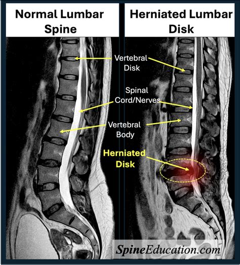 Herniated Disc Spine Education
