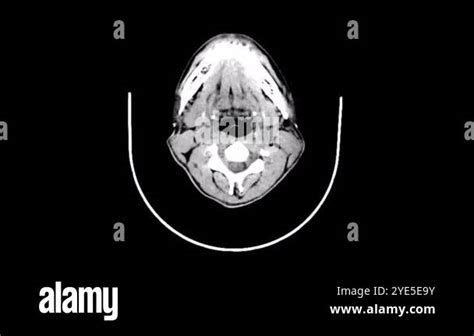 Computed Tomography Ct Scan Of An 18 Year Old Man With
