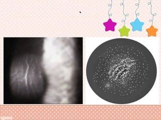 Diffuse Lamellar Keratitis DLK PPT Eye And Vision Conditions Diseases And Conditions