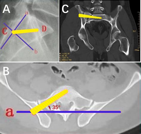 51 Year Old Male With Tile Type B2 Pelvic Fracture A Lateral