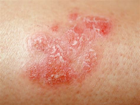 Maladies De La Peau Psoriasis Psoriasis Photos And Symptoms Sclh