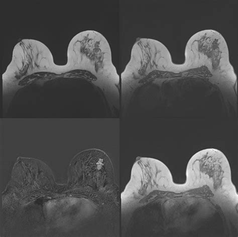 Cancer Detection Rate Of Breast Mr In Supplemental Screening After