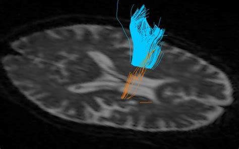 A Lesion And Corticospinal Tract Cst Of Patient 1 Right Ischemic