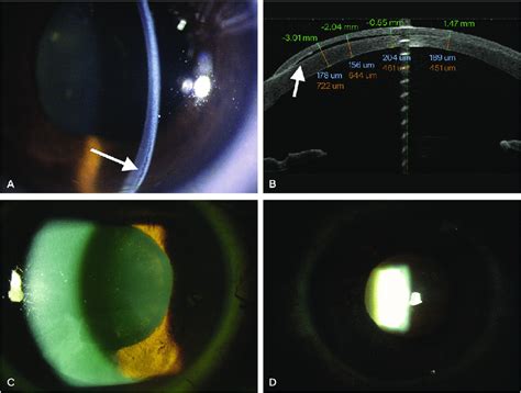 Initial Presentation Three Weeks After Lasik A Inferior Fluid Cleft