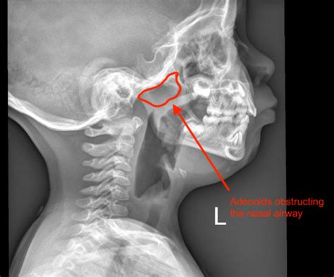 Adenoids Dr Jeeve Ent Specialist
