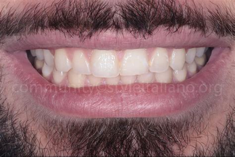 Restoring And Preserving Esthetics Through A Healthy Dynamic Occlusal Function