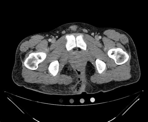 Fourniers Gangrene Female Fournier Gangrene Causes Symptoms