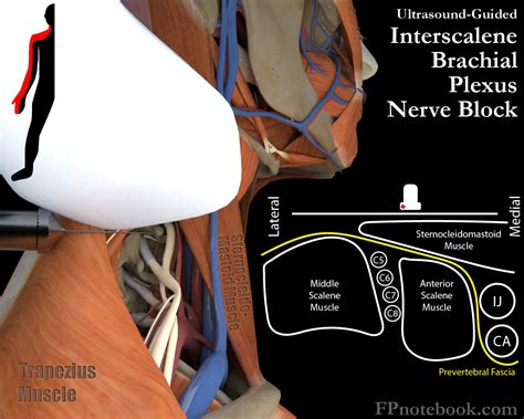 Interscalene Block