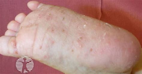 Acropustulosis Of Infancy Image