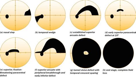 Which Is And Nasal Visual Field Interpretation