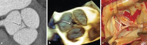 14 The Aortic Valve Radiology Key