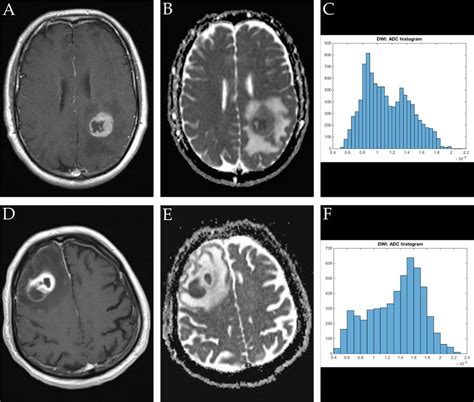 Imaging Findings And Corresponding Adc Histograms Of Morphologically Download Scientific