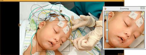 Nicu Eeg For Neonate Brain Health Monitoring Cadwell Eeg