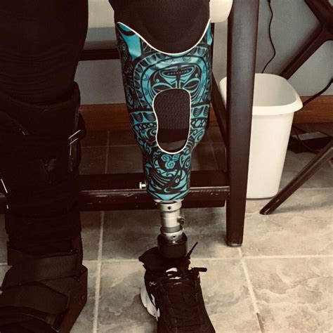 Prosthetic Socket Designs At Jennifer Quevedo Blog