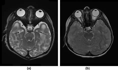 Cmv Retinitis Mri
