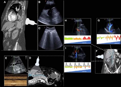 Description Of The Protocol Study Position Of The Probe In Lung
