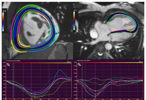 Segmental Cmr Feature Tracking In The Short And Long Axis Of The Rv Download Scientific