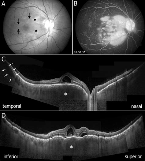 Fundus Photograph A A Late Phase 10 Minutes And 55 Seconds Image