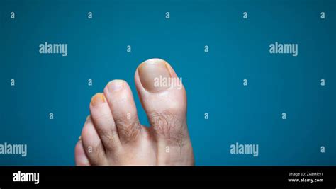 What Causes Hairy Feet At Isabella Embry Blog