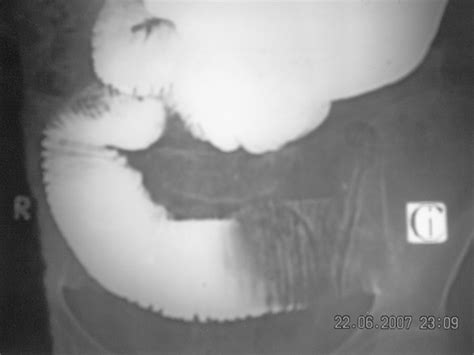 Barium Meal Study Of The Patient Giving Impression Of Intussusception