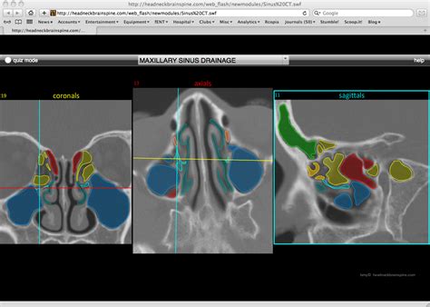 Head Mri And Ct Scans Explained Fauquier Ent Blog