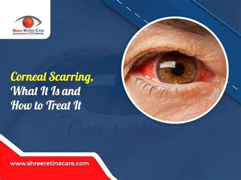 Corneal Scarring What It Is And How To Treat It