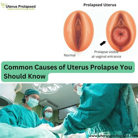 Common Causes Of Uterus Prolapse You Should Know