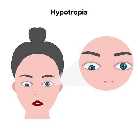 Premium Vector Eye Problem Disease Strabismus Hypotropia