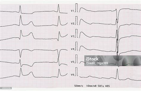 Ecg Con Aguda Período De Macrofocal Infarto De Miocardio Posterior Foto