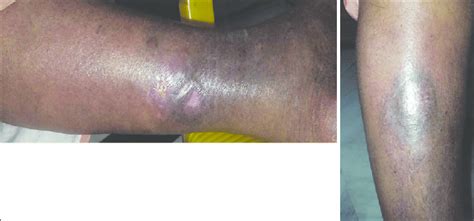 After 6 Weeks Of Stopping Methotrexate Ulcers Showing Almost Complete Download Scientific