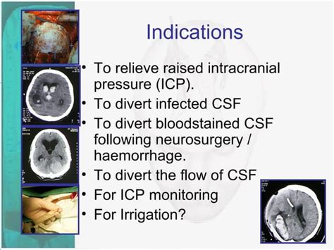 External Ventricular Drain Ppt