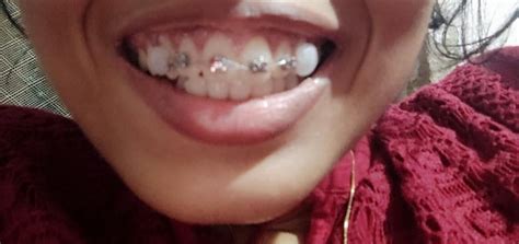 Braces Treatment Gone Wrong R Orthodonticvictims