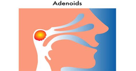 Adenoidectomy Adenoid Removal Why Its Done Risks What To Expect
