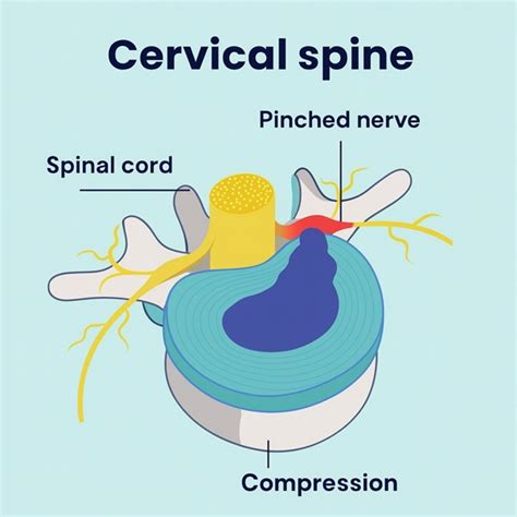 Is Cervical Radiculopathy A Pinched Nerve