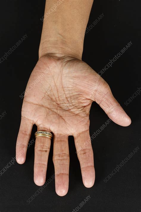 Hyperlinear Palm In Atopic Dermatitis Stock Image C0561999
