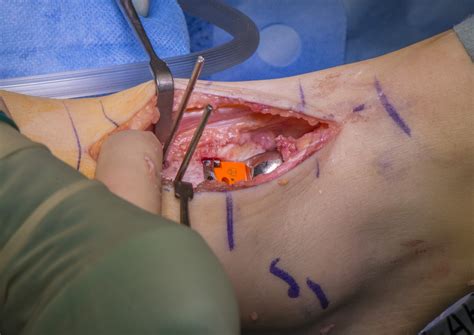 Ankle Replacement Wright Prophecy Orthoracle Luanmd