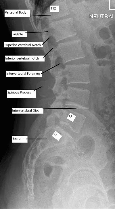 Lumbar Spine Anatomy Xray