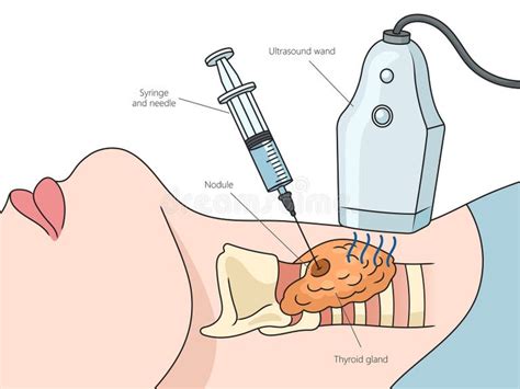 Thyroid Puncture Stock Illustrations 4 Thyroid Puncture Stock Illustrations Vectors And Clipart