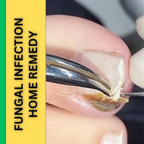 Home Remedies For Fungal Skin Infections V Beautify