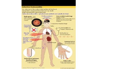 Infective Endocarditis Definition Infection Of The Endocardial Surface