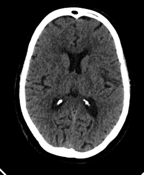 Foix Chavany Marie Syndrome Due To Unilateral Opercular Infarction—a Case Report Yadav 2024