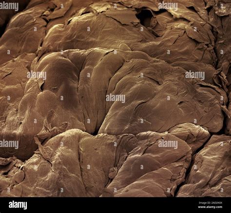 Skin Mole Coloured Scanning Electron Micrograph Sem Of Detail From A Human Skin Mole Moles